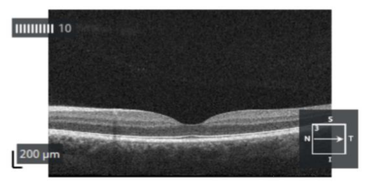 Intravitreal Injection Therapy – iCare Surgical Centre